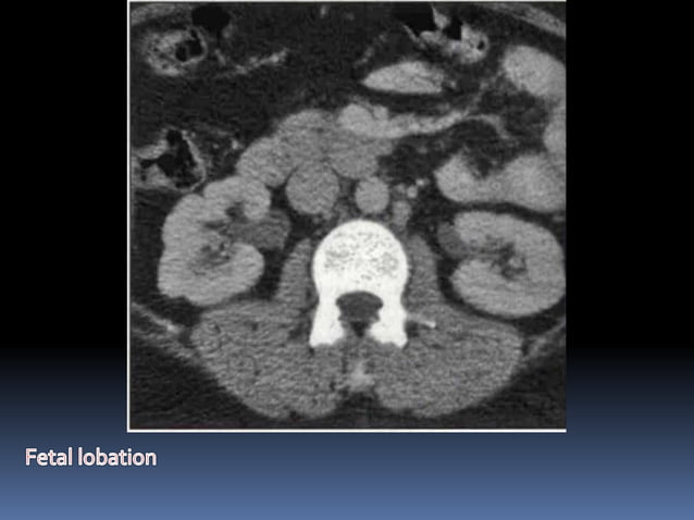 SOLID RENAL MASSES imaging | PPTX