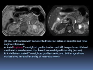 SOLID RENAL MASSES imaging | PPTX