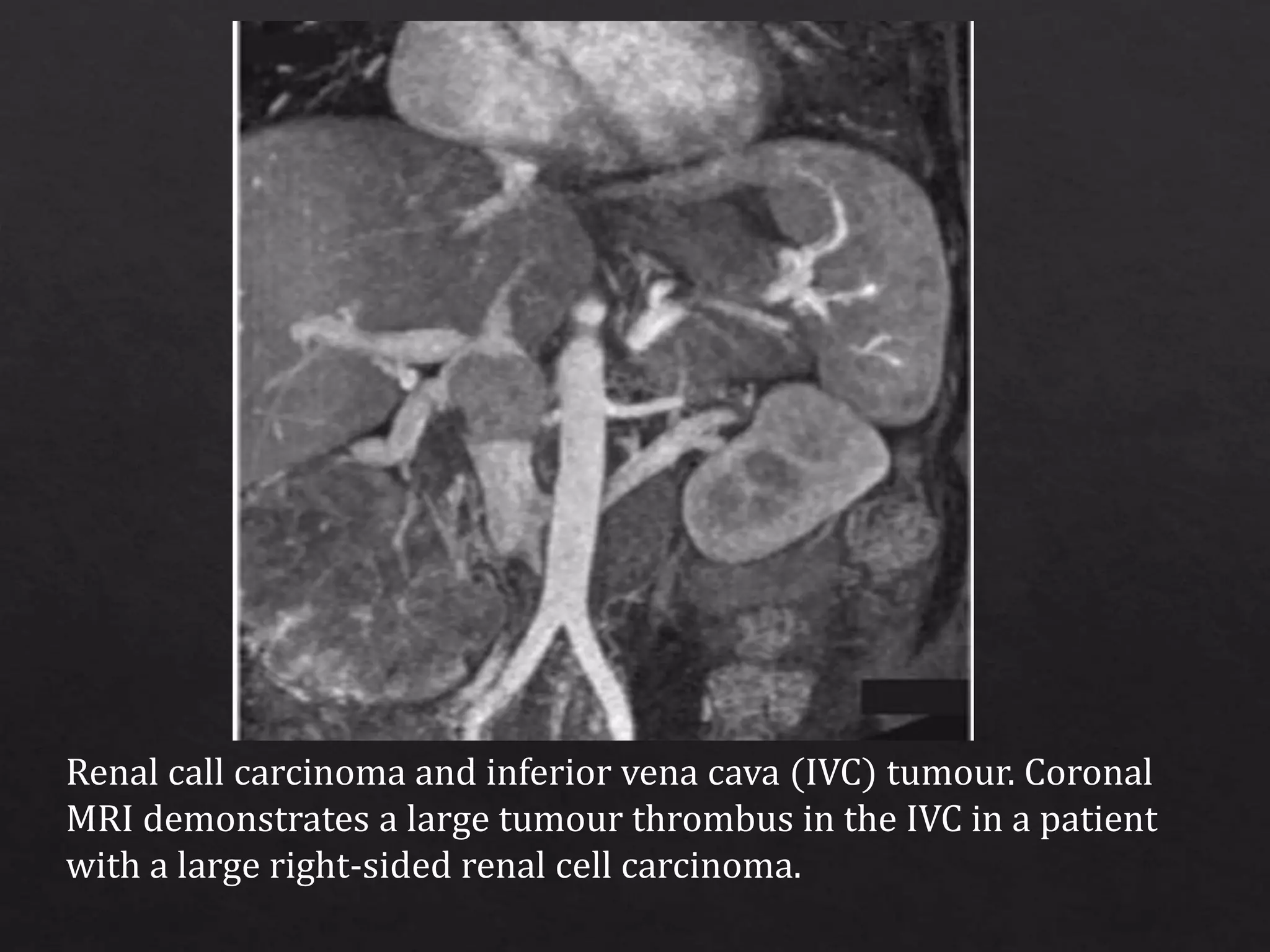 Imaging of Renal Tumors | PPTX