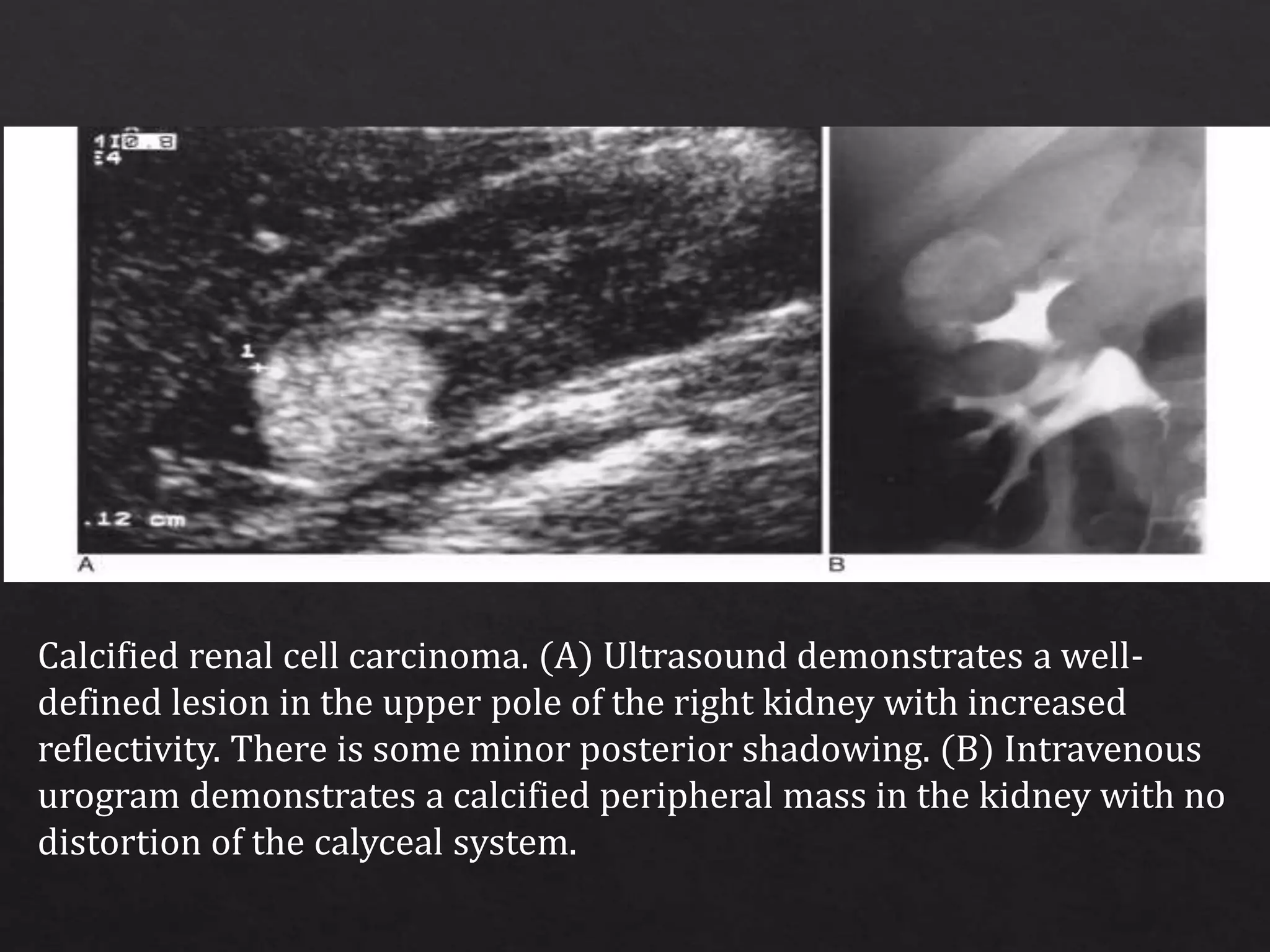 Imaging of Renal Tumors | PPTX