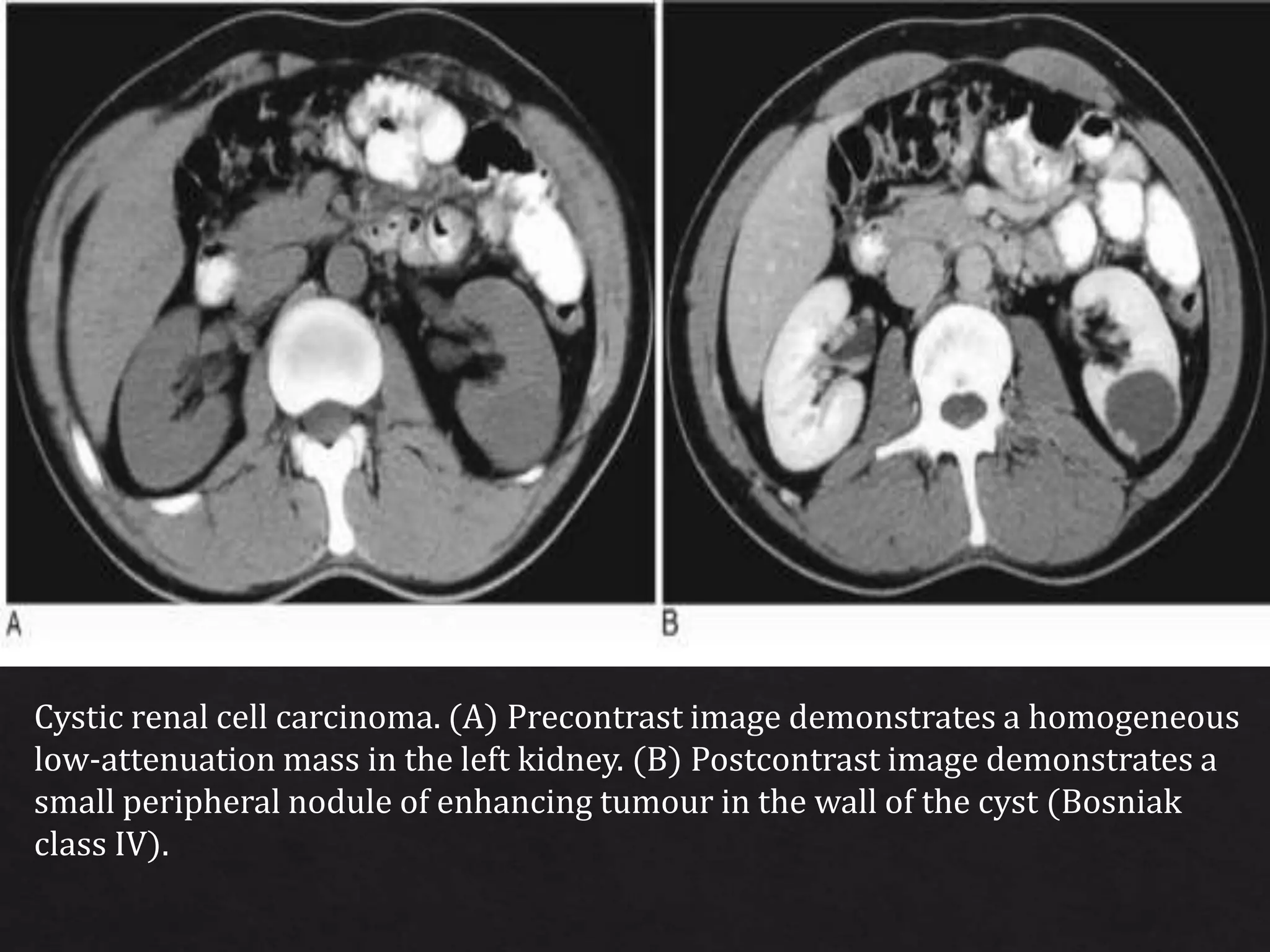 Imaging of Renal Tumors | PPTX