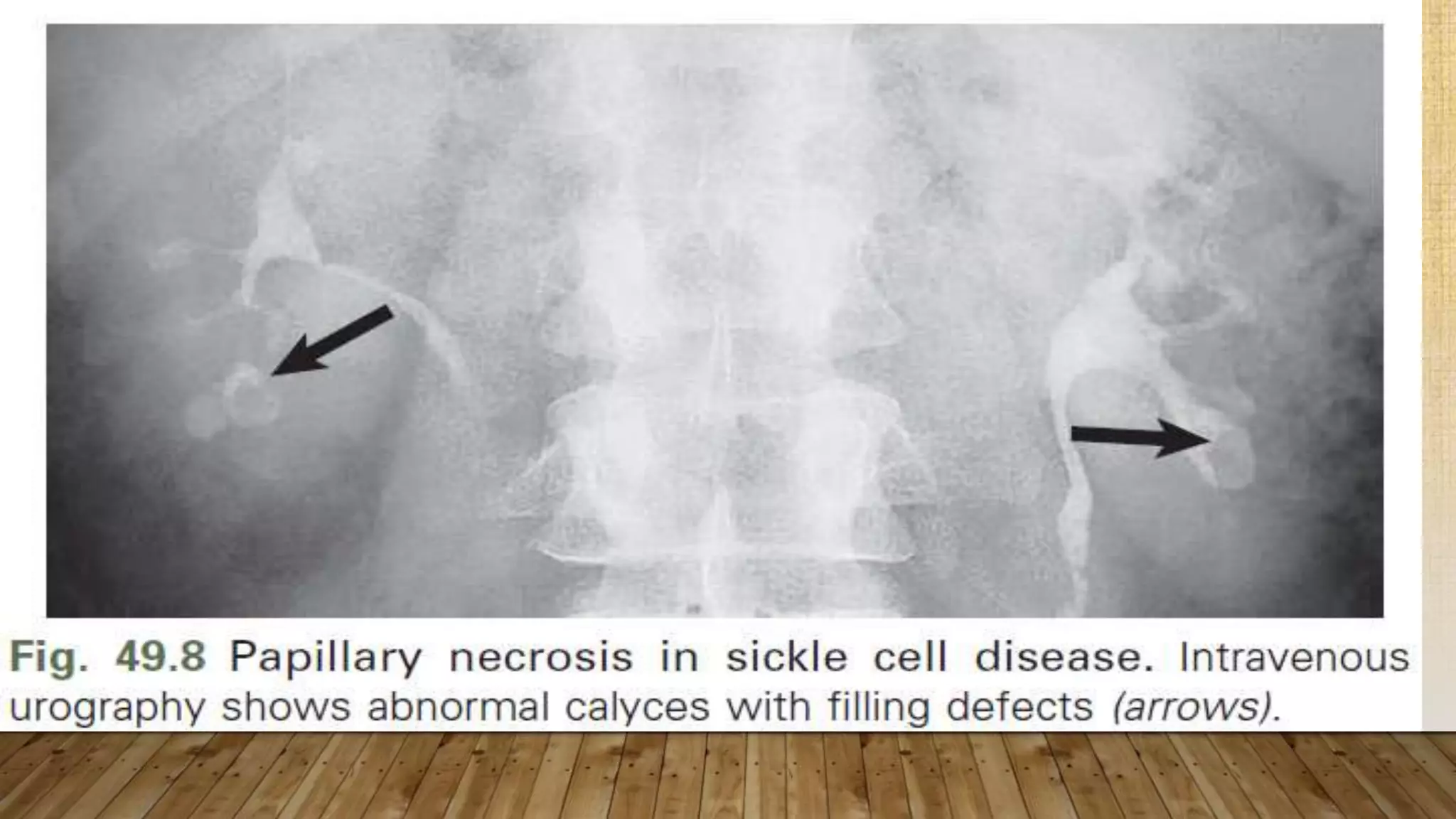 Renal Papillary Necrosis.pptx