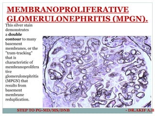 Membranoproliferative Glomerulonephritis Tram Track