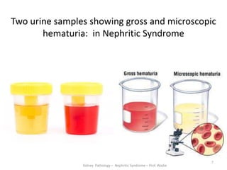 Renal pathology the nephritic syndrome- prof wadie | PPTX