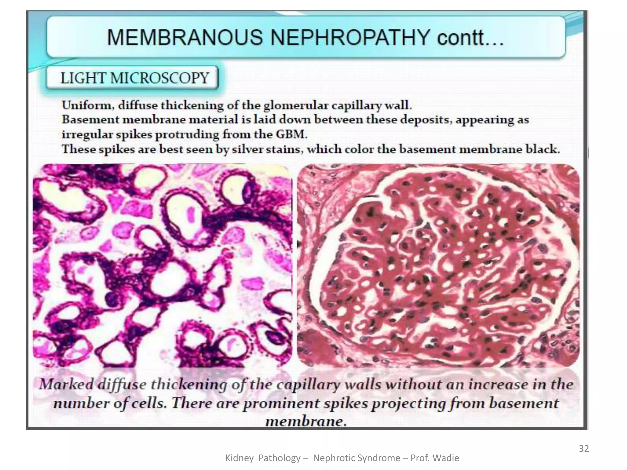 Renal pathology the nephrotic syndrome- prof wadie | PPTX