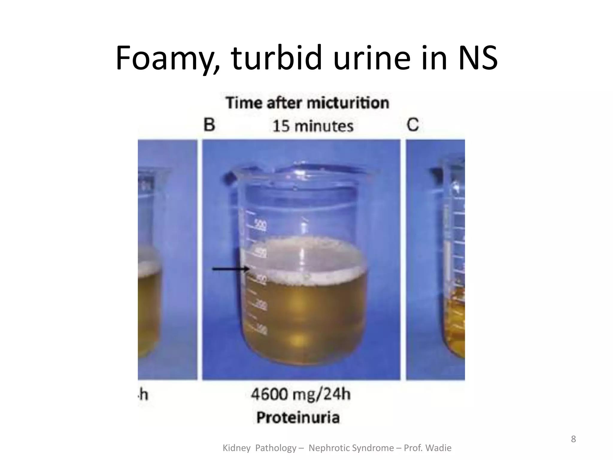 Renal pathology the nephrotic syndrome- prof wadie | PPTX
