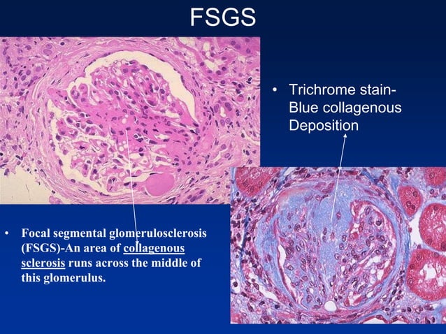 Renal pathology ii | PPT