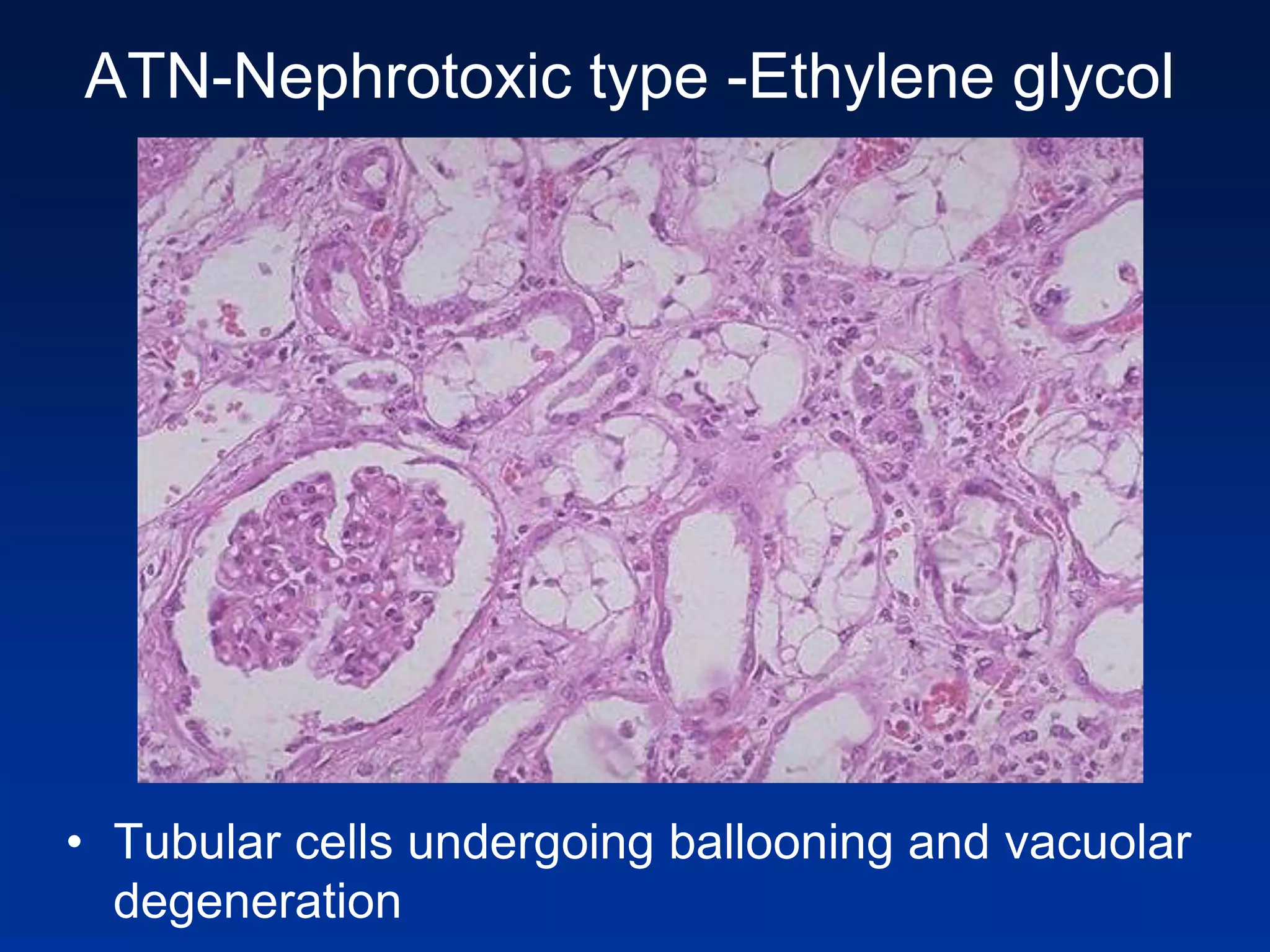 Renal pathology iii | PPT