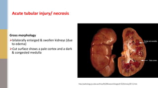 Renal pathology. Lecture 1 acute kidney injury, sufia husain 2020 | PPTX