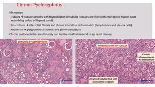 Renal pathology lecture 2&3. Infection of upper and lower urinary tract ...