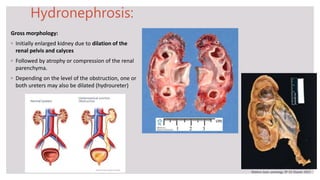 Renal pathology lecture 2&3. Infection of upper and lower urinary tract ...