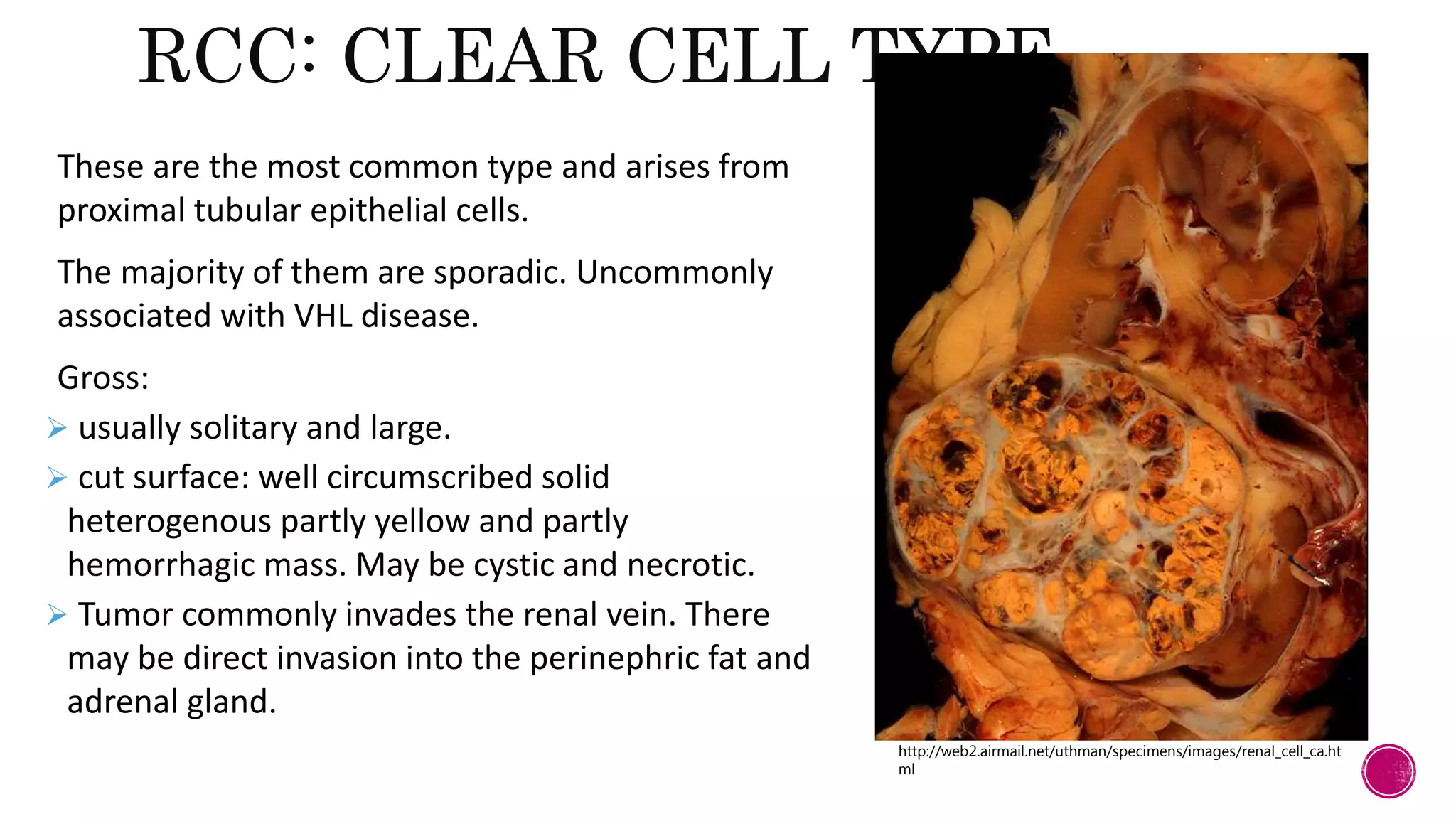 Renal pathology lecture 4 Tumors of kidney and urinary tract. Sufia ...
