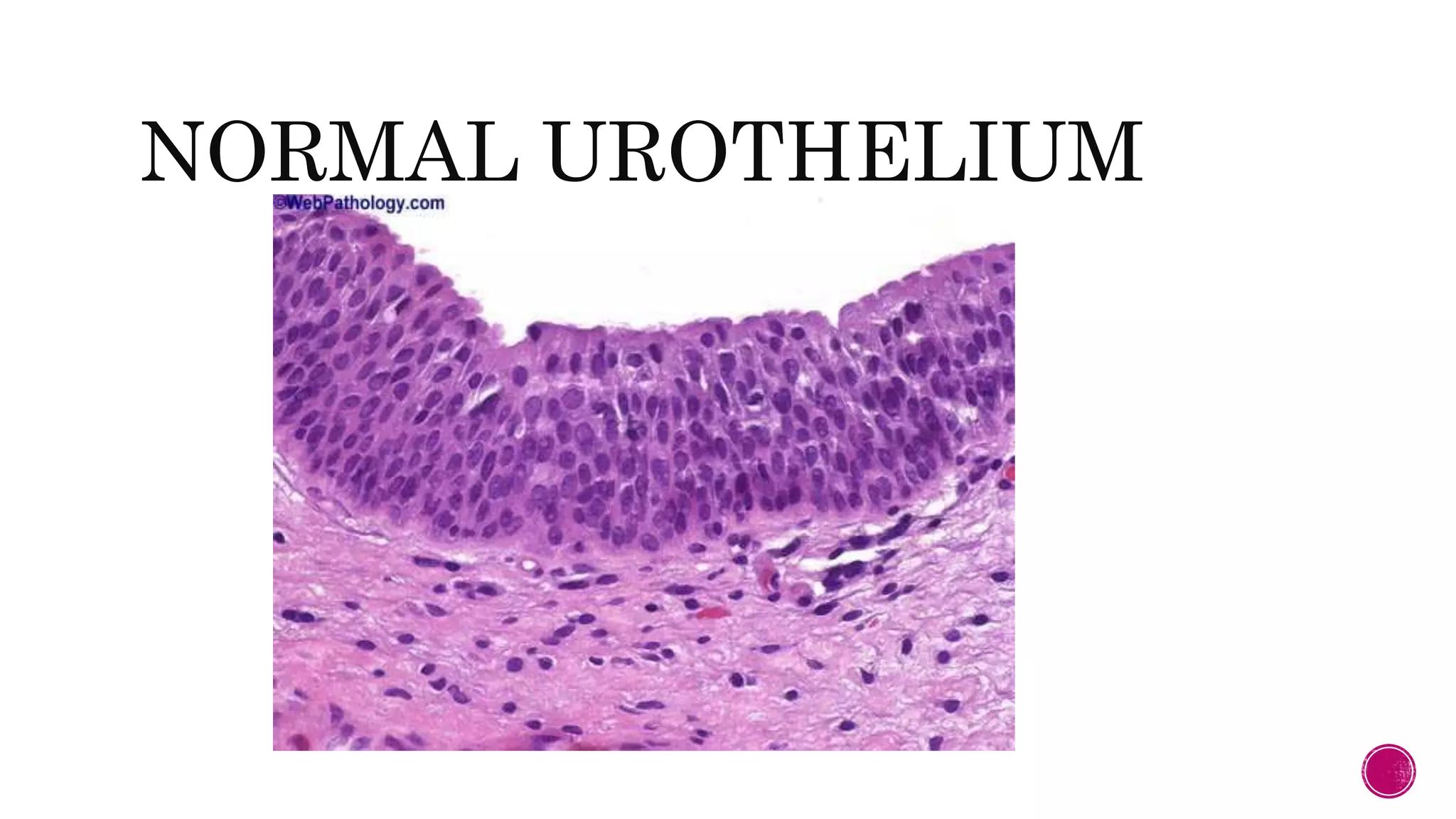 Renal pathology lecture 4 Tumors of kidney and urinary tract. Sufia ...