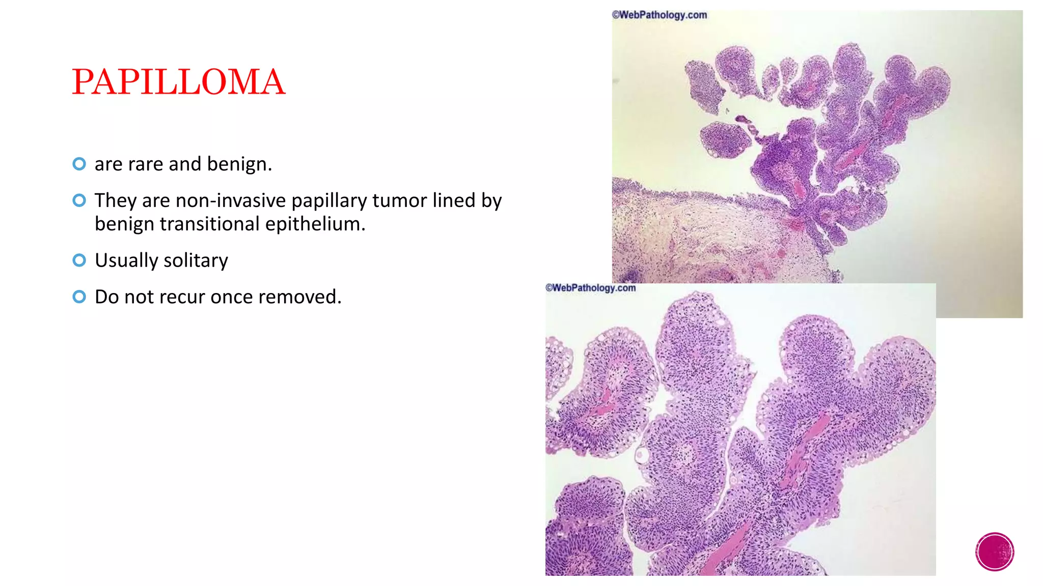 Renal pathology lecture 4 Tumors of kidney and urinary tract. Sufia ...