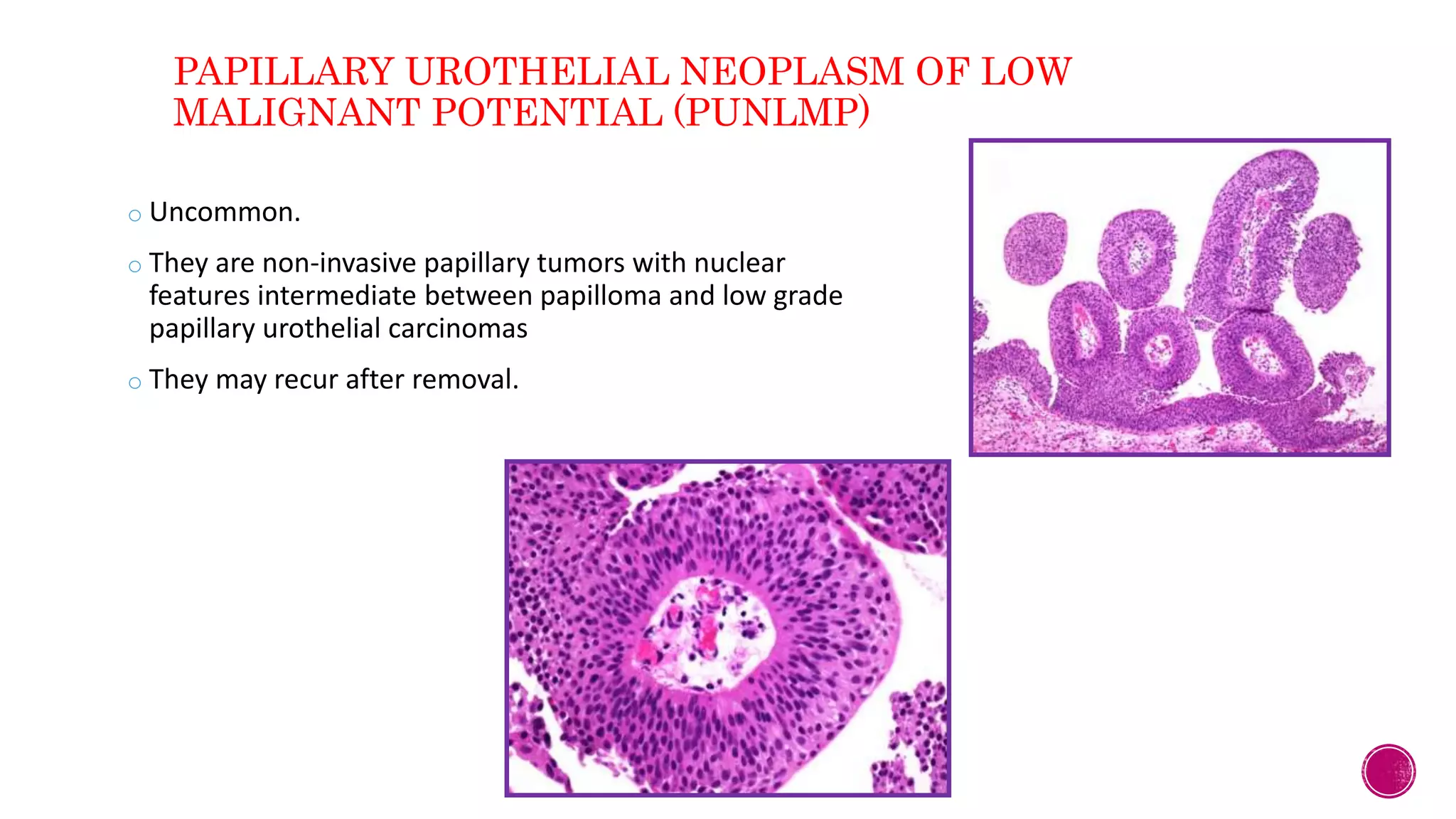 Renal pathology lecture 4 Tumors of kidney and urinary tract. Sufia ...