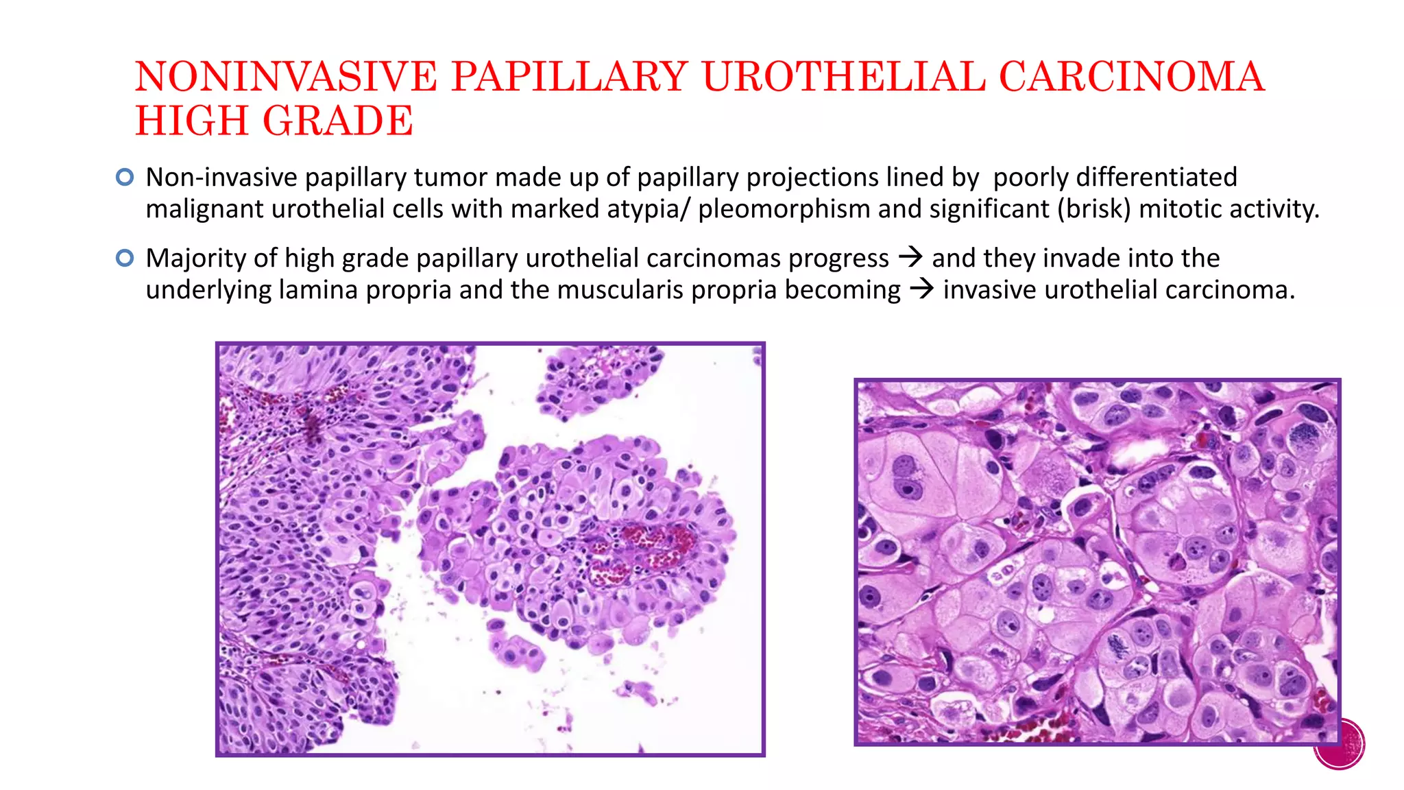 Renal pathology lecture 4 Tumors of kidney and urinary tract. Sufia ...