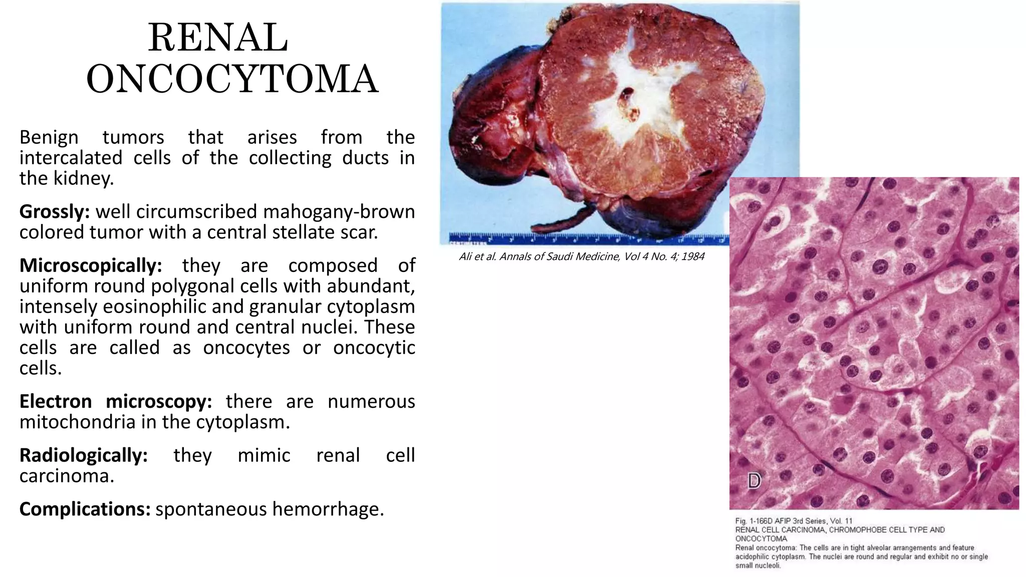 Renal pathology lecture 4 Tumors of kidney and urinary tract. Sufia ...
