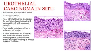 Renal pathology lecture 4 Tumors of kidney and urinary tract. Sufia ...
