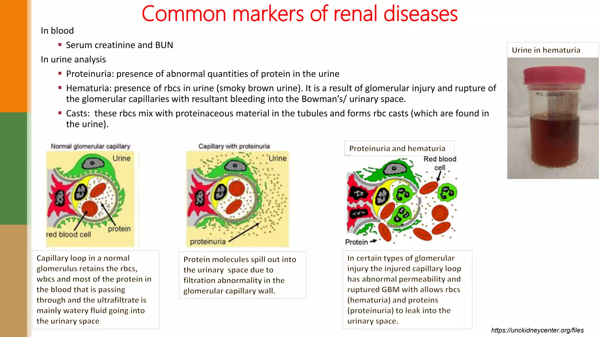 Renal pathology lecture5 Nephrotic & Nephritic syndrome. Sufia Husain ...