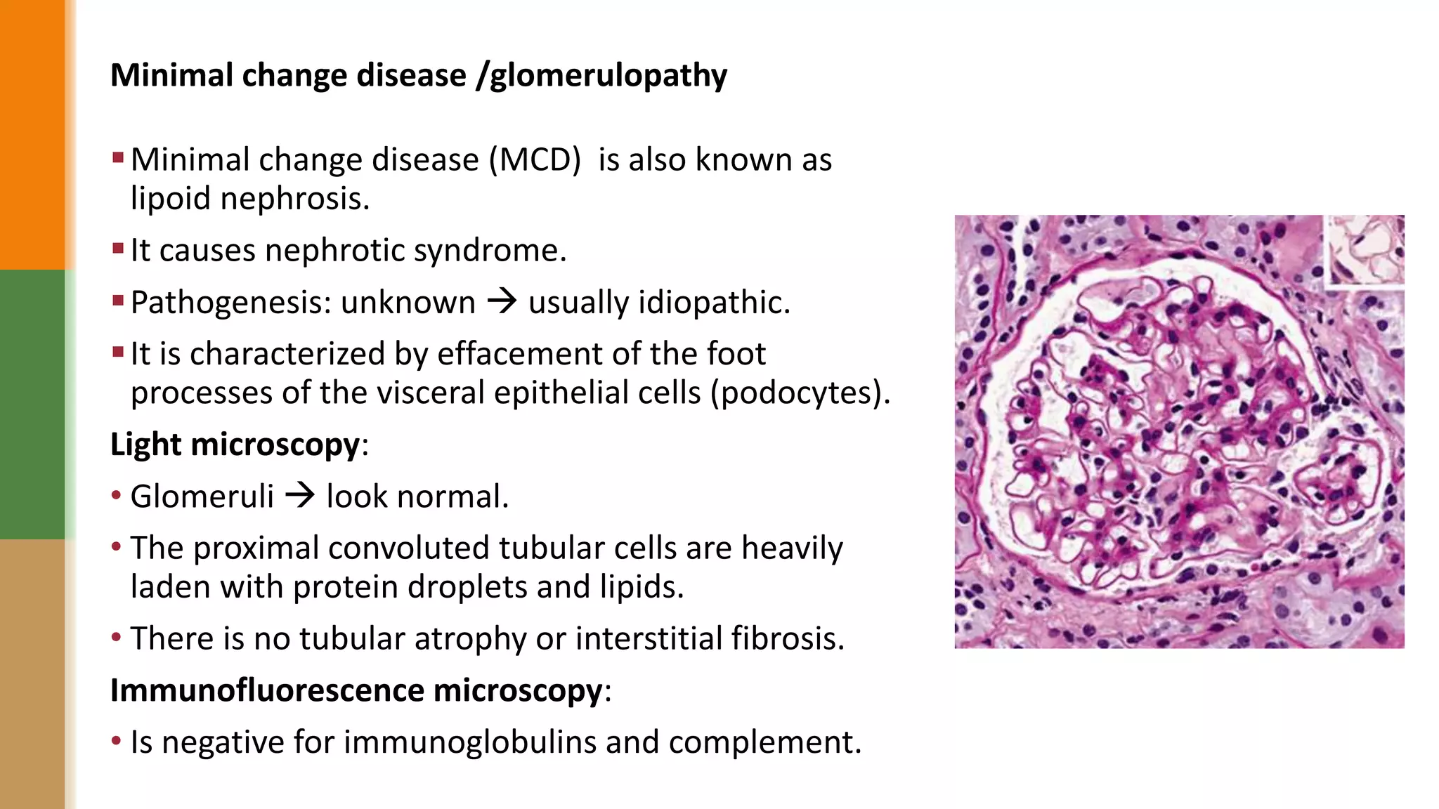 Renal pathology lecture5 Nephrotic & Nephritic syndrome. Sufia Husain ...