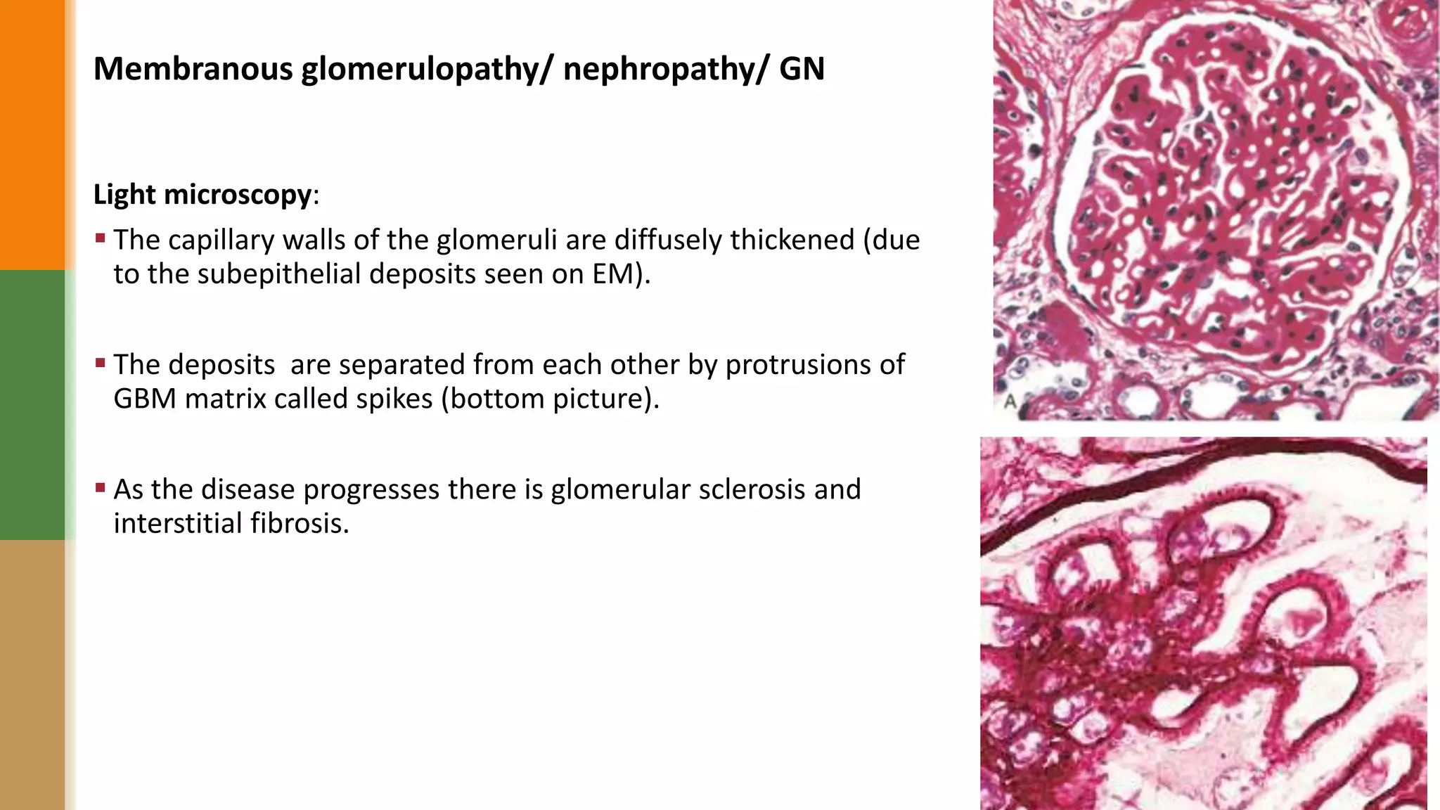 Renal pathology lecture5 Nephrotic & Nephritic syndrome. Sufia Husain ...