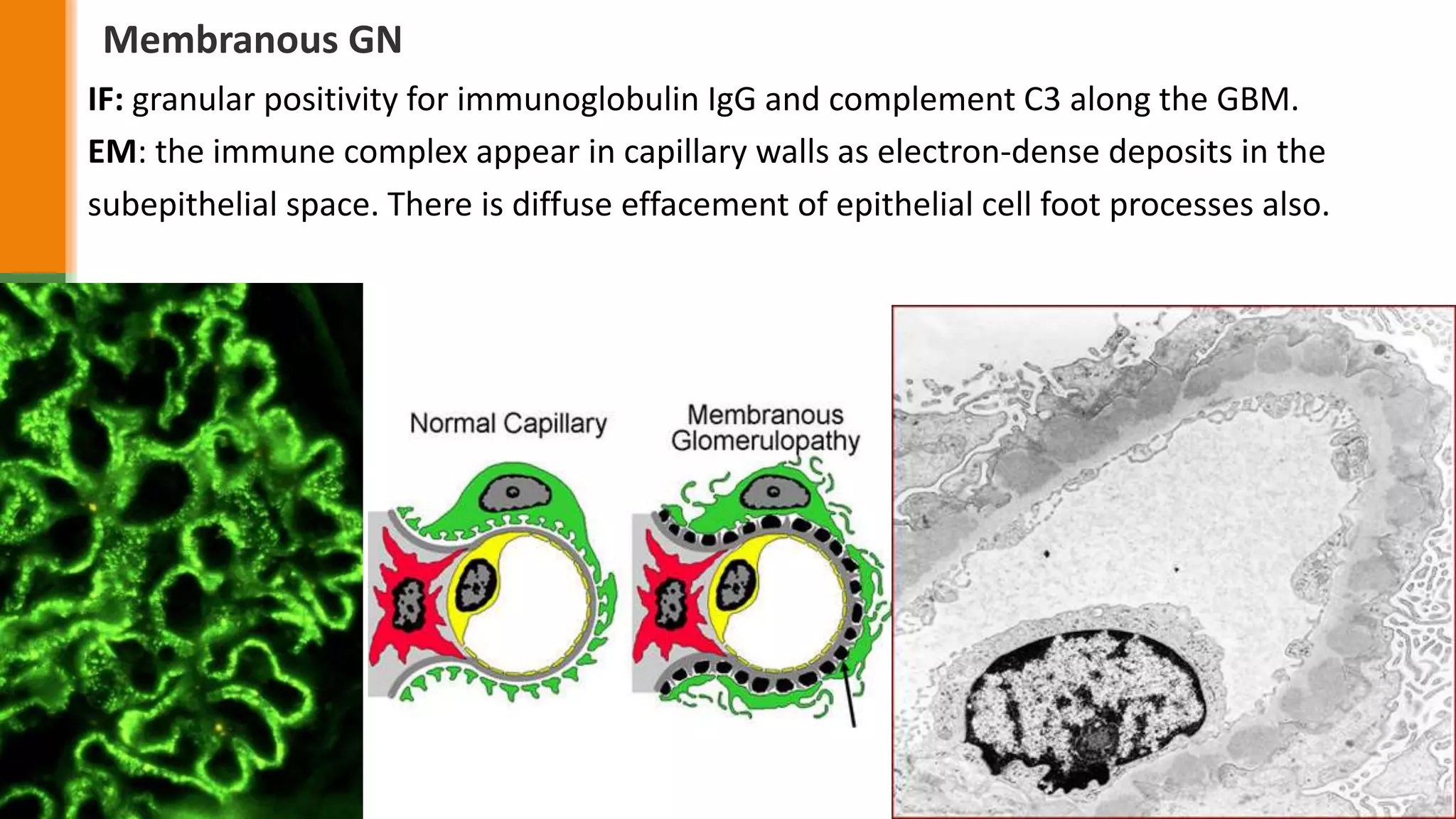 Renal pathology lecture5 Nephrotic & Nephritic syndrome. Sufia Husain ...