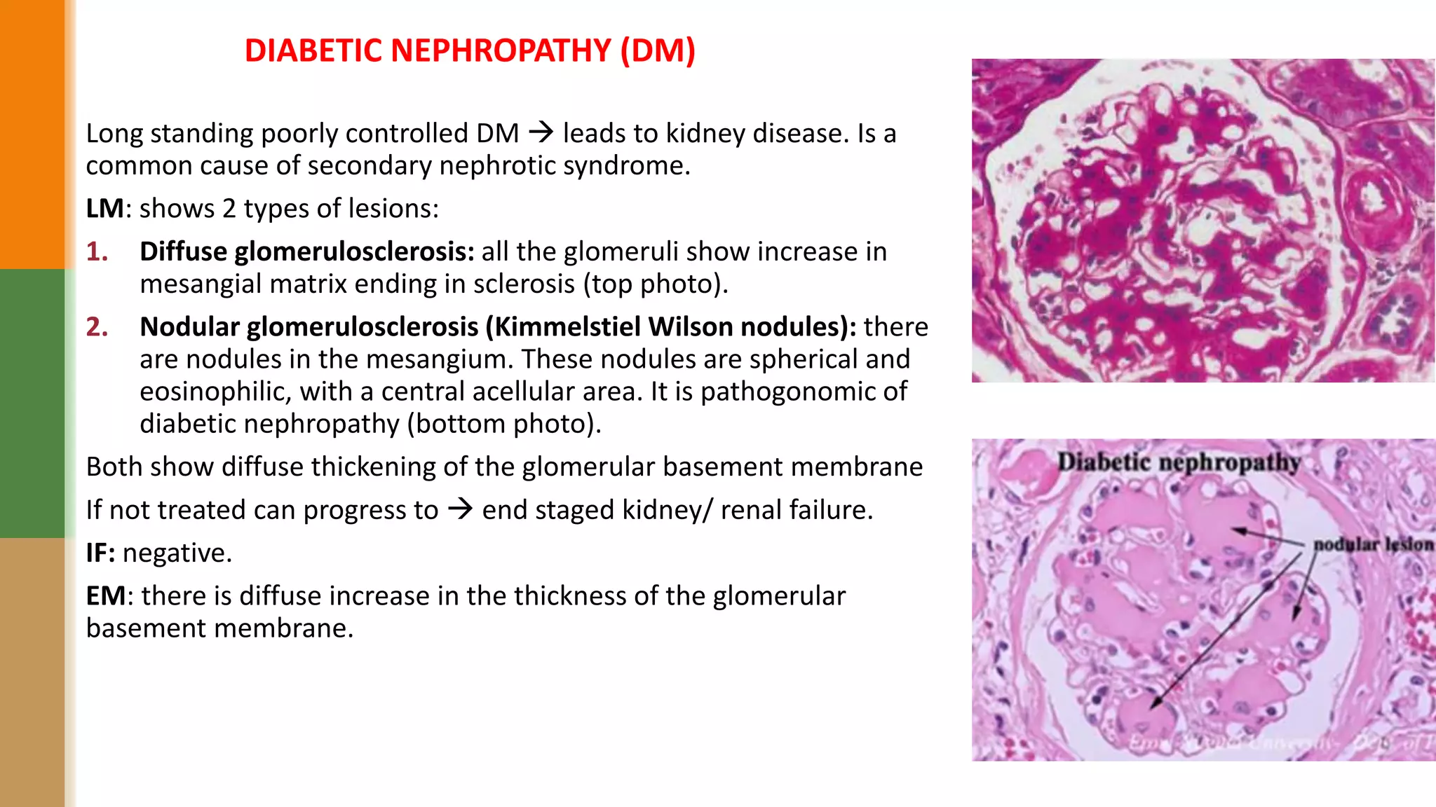 Renal pathology lecture5 Nephrotic & Nephritic syndrome. Sufia Husain ...