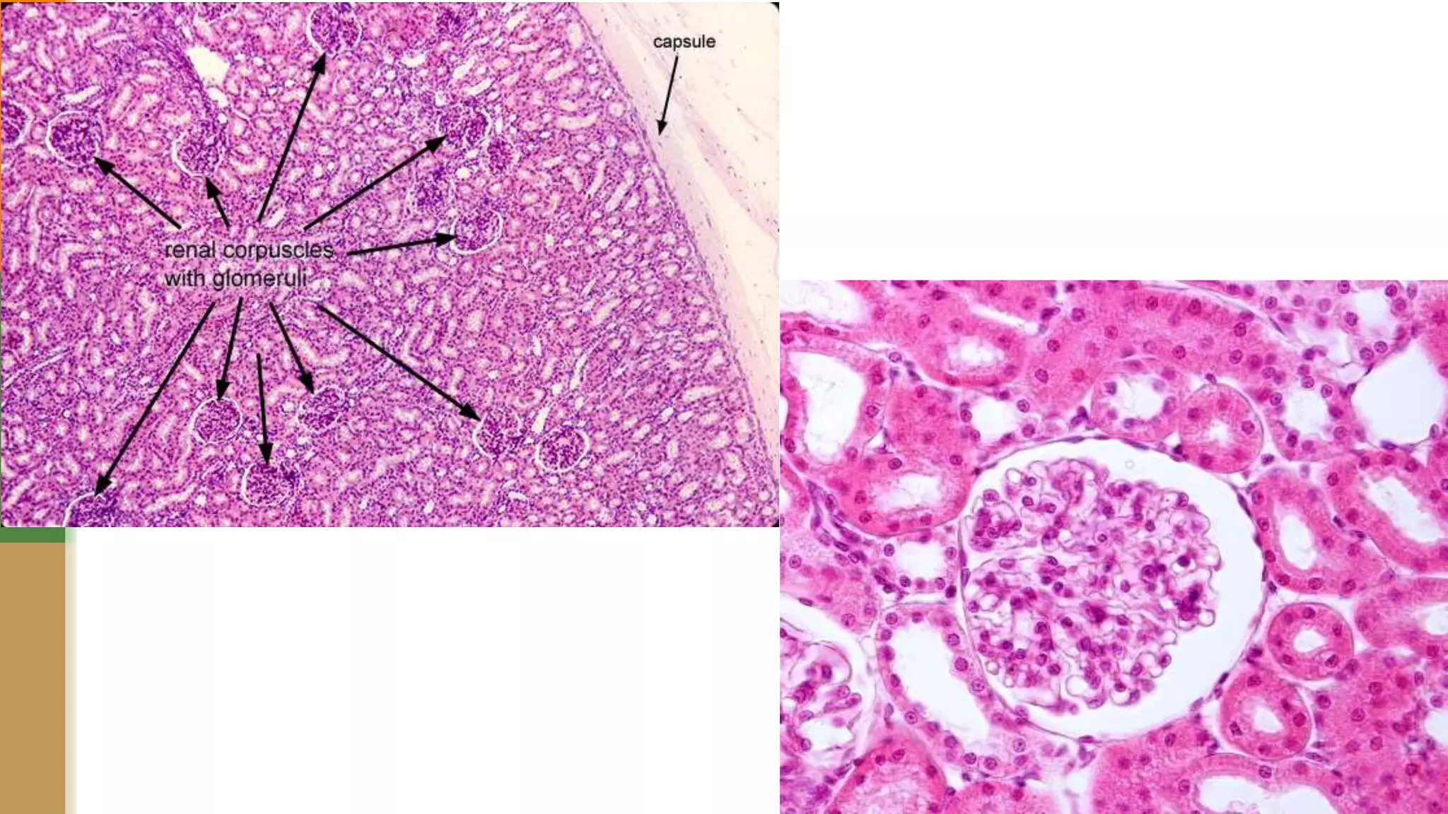 Renal pathology lecture5 Nephrotic & Nephritic syndrome. Sufia Husain ...