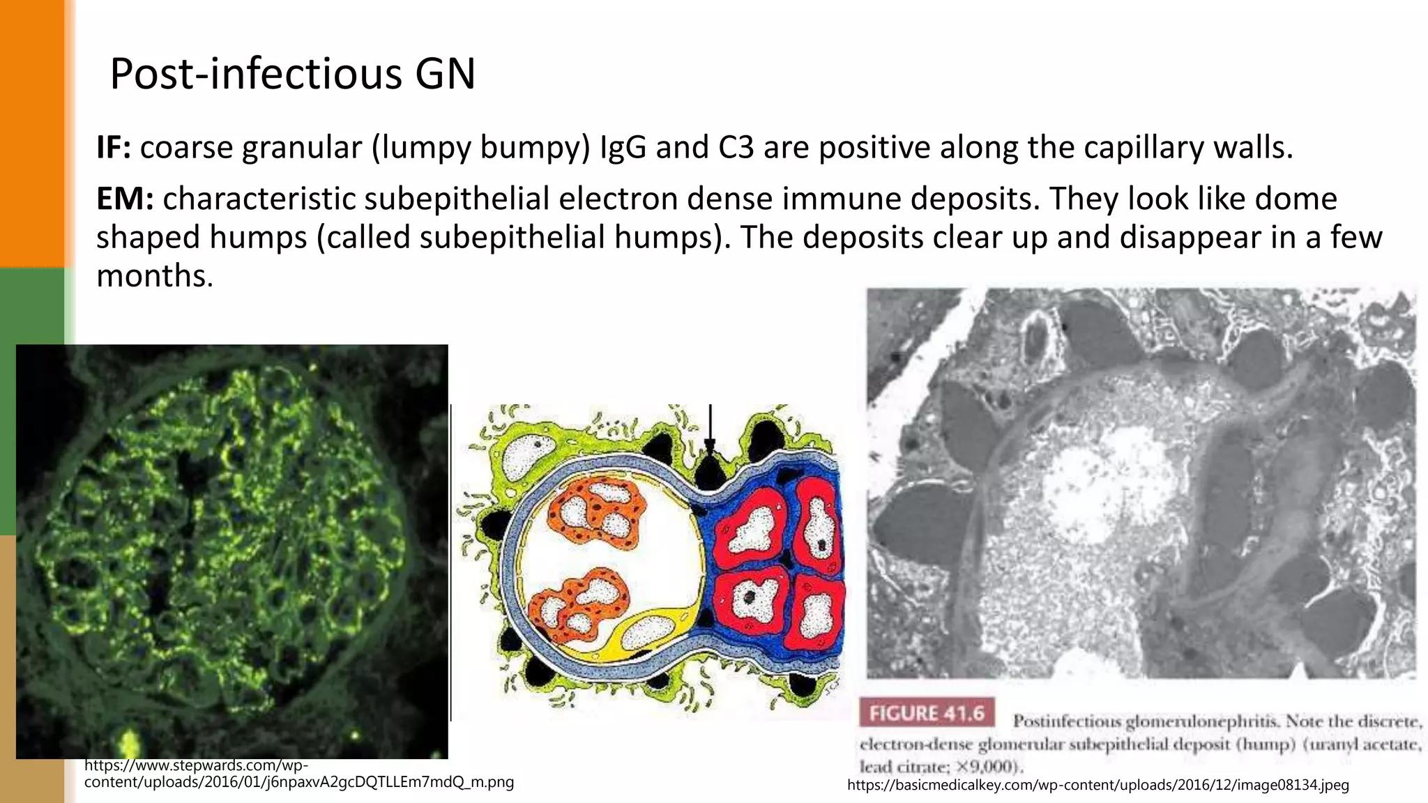 Renal pathology lecture5 Nephrotic & Nephritic syndrome. Sufia Husain ...