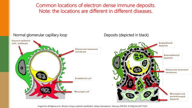 Renal pathology lecture5 Nephrotic & Nephritic syndrome. Sufia Husain ...