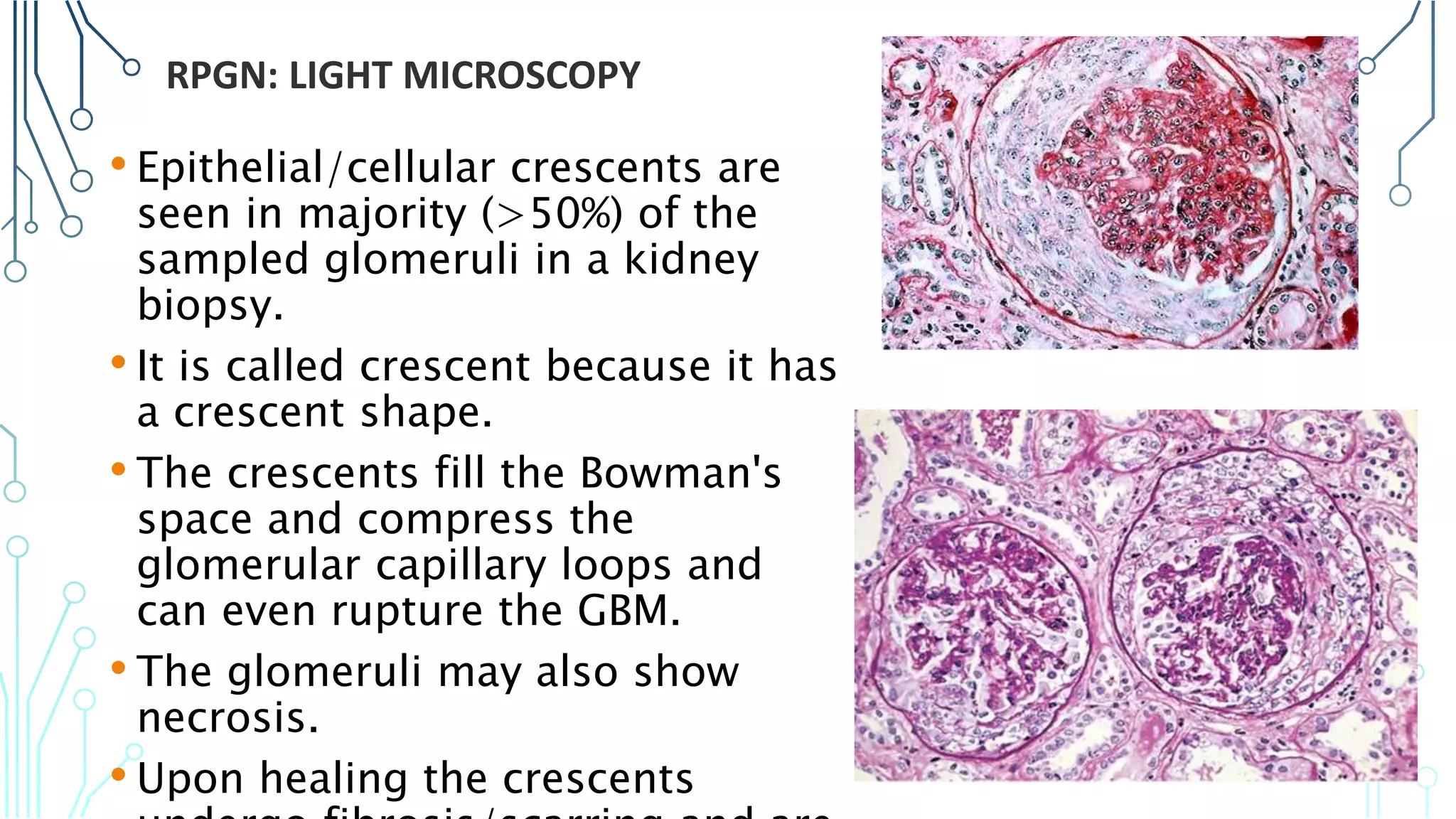 Renal pathology lecture 6 Rapid Progressive Glomerulonephritis ...