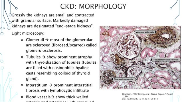 Renal pathology lecture 6 Rapid Progressive Glomerulonephritis ...