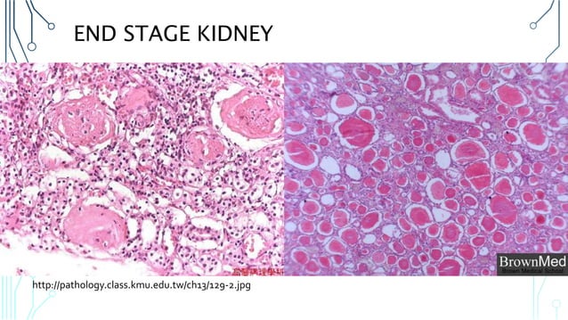 Renal pathology lecture 6 Rapid Progressive Glomerulonephritis ...