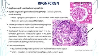 Renal pathology lecture 6 Rapid Progressive Glomerulonephritis ...