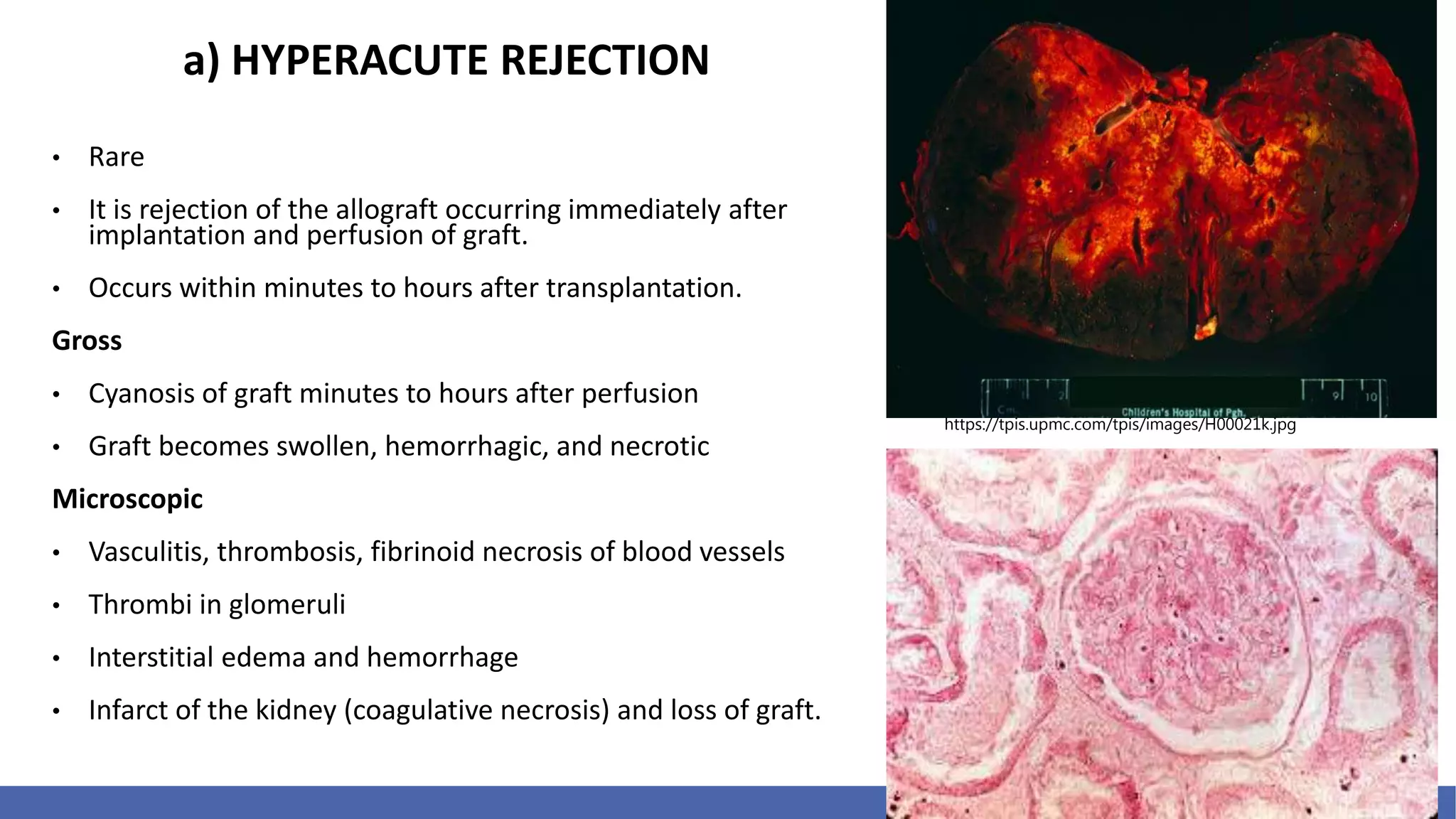 Renal pathology. Lecture 7 Introduction to Allograft Kidney Pathology ...