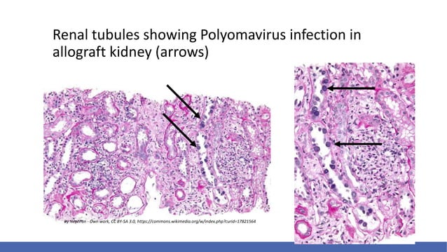 Renal pathology. Lecture 7 Introduction to Allograft Kidney Pathology. Sufia Husain 2020 | PPTX ...