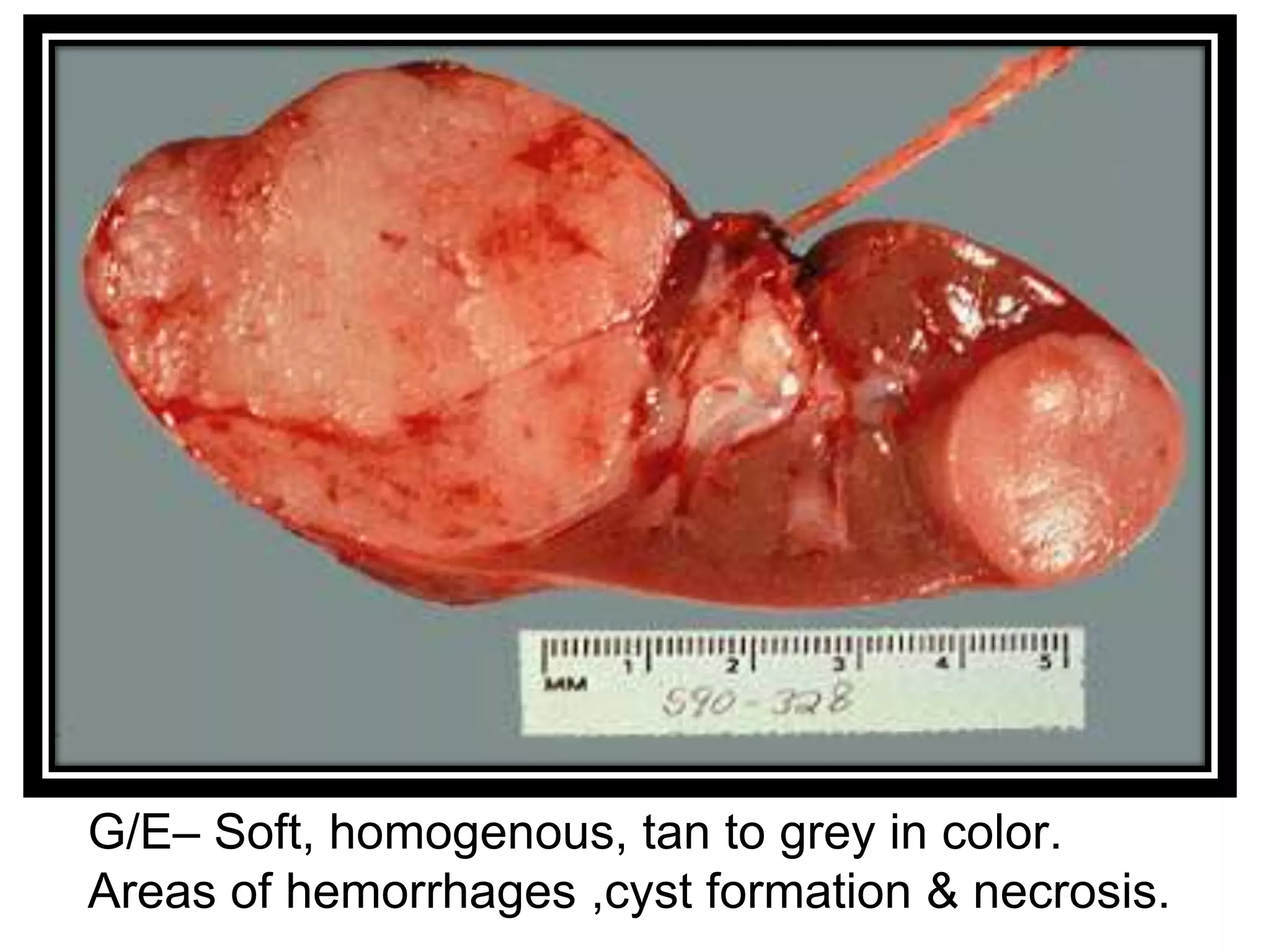 Renal pediatric tumors | PPTX