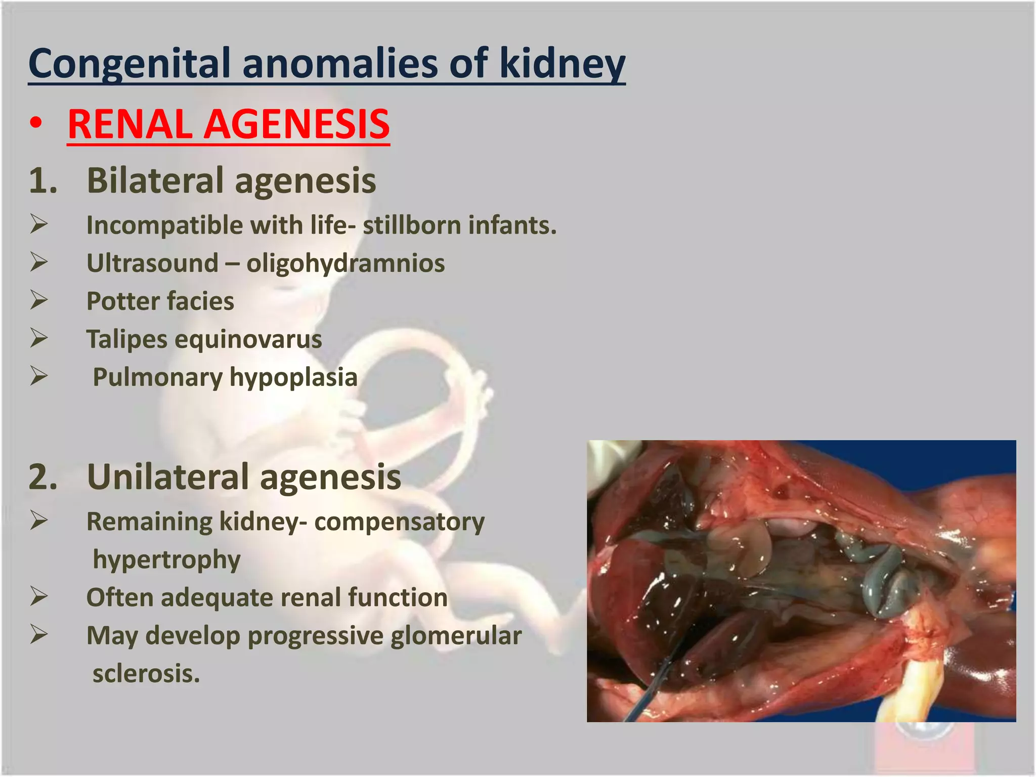 Developmental anomalies of Renal system | PPTX