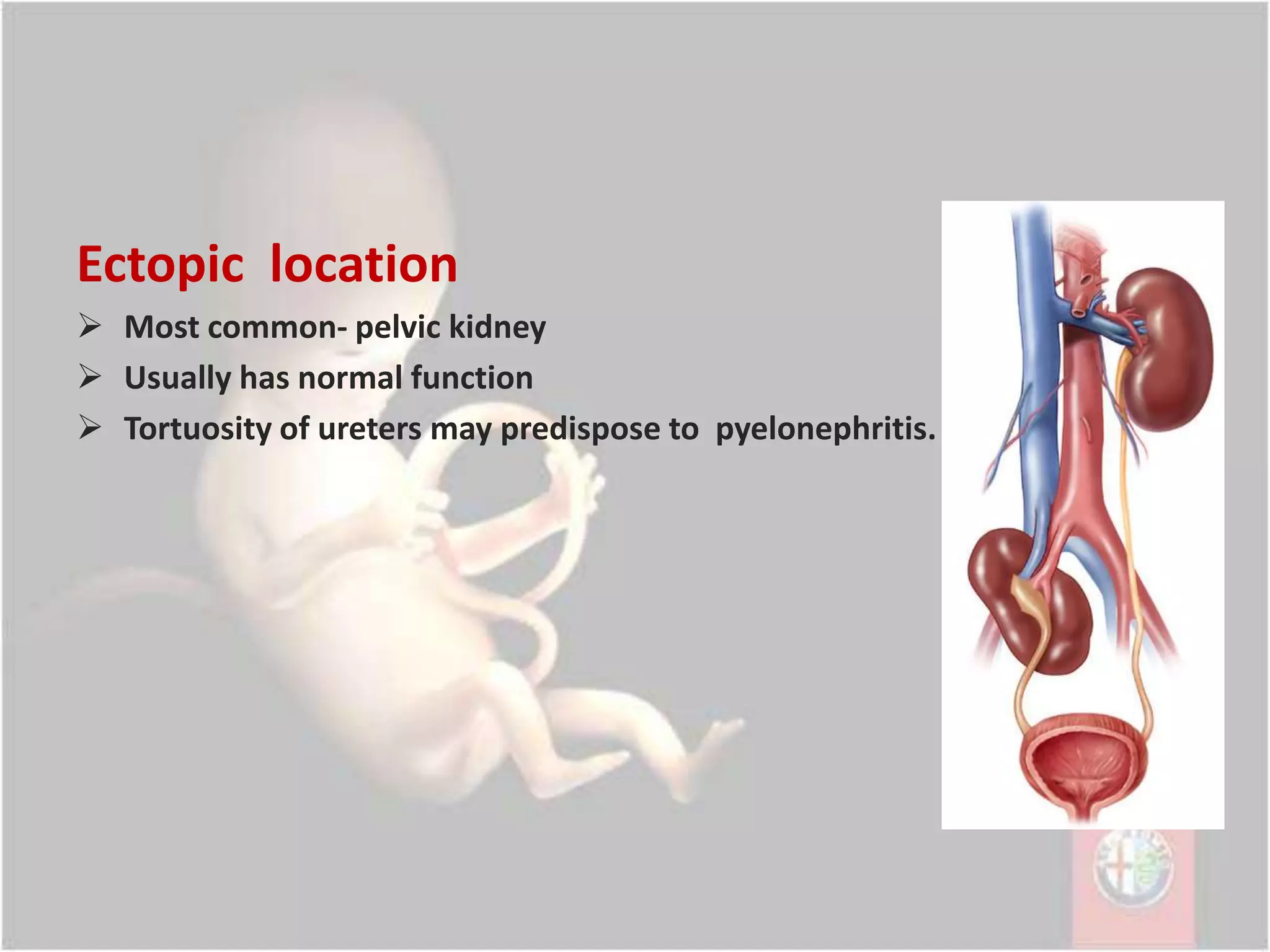 Developmental anomalies of Renal system | PPTX