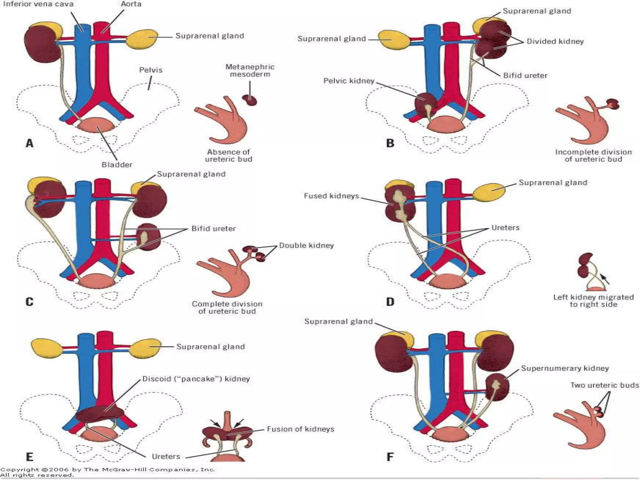 Developmental anomalies of Renal system | PPTX