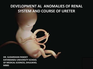 Developmental anomalies of Renal system | PPTX