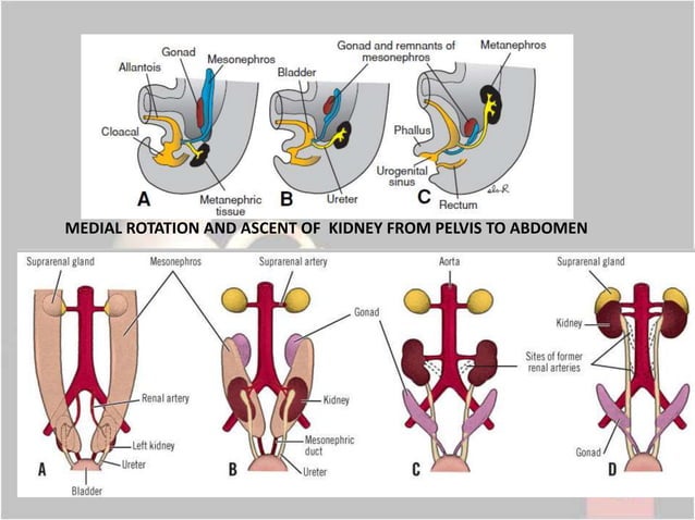 Developmental anomalies of Renal system | PPTX