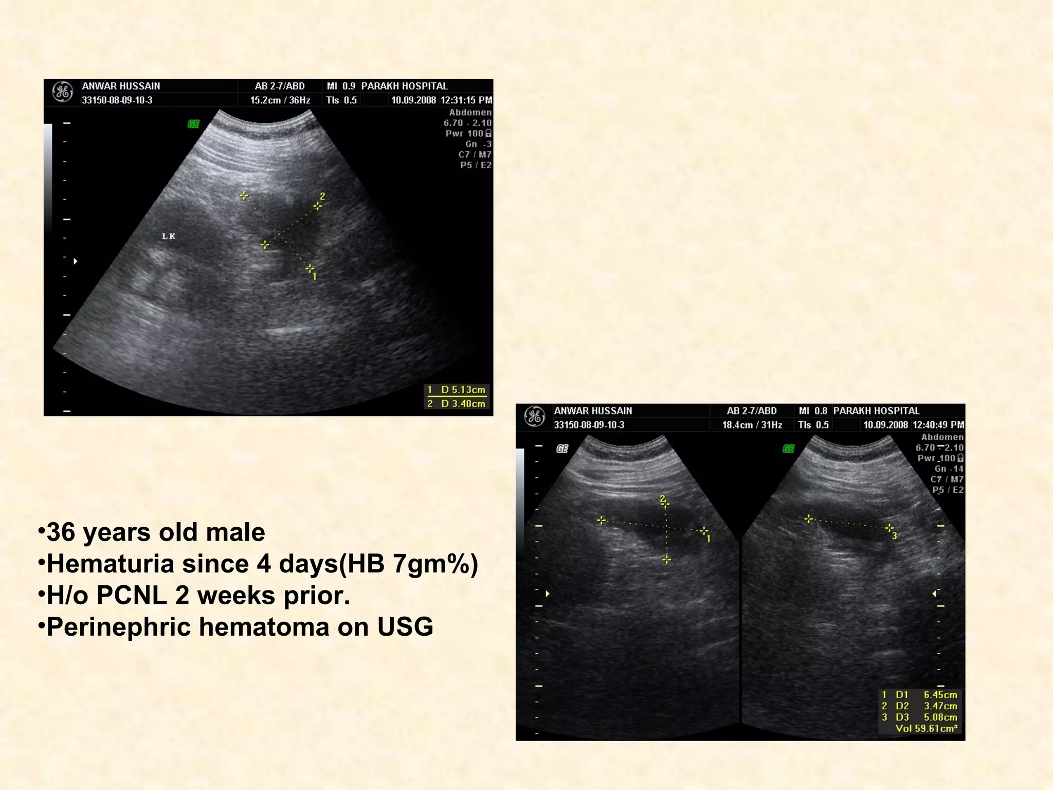 Embolisation for a post PCNL renal pseudoaneurysm. | PPT
