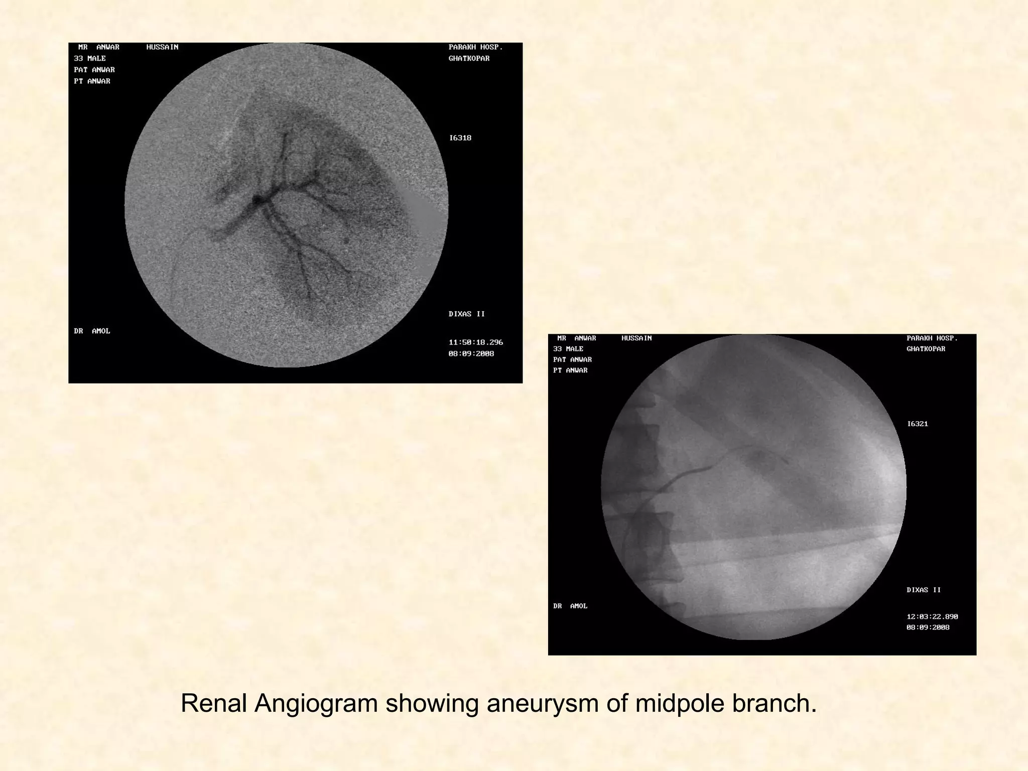 Embolisation for a post PCNL renal pseudoaneurysm. | PPT