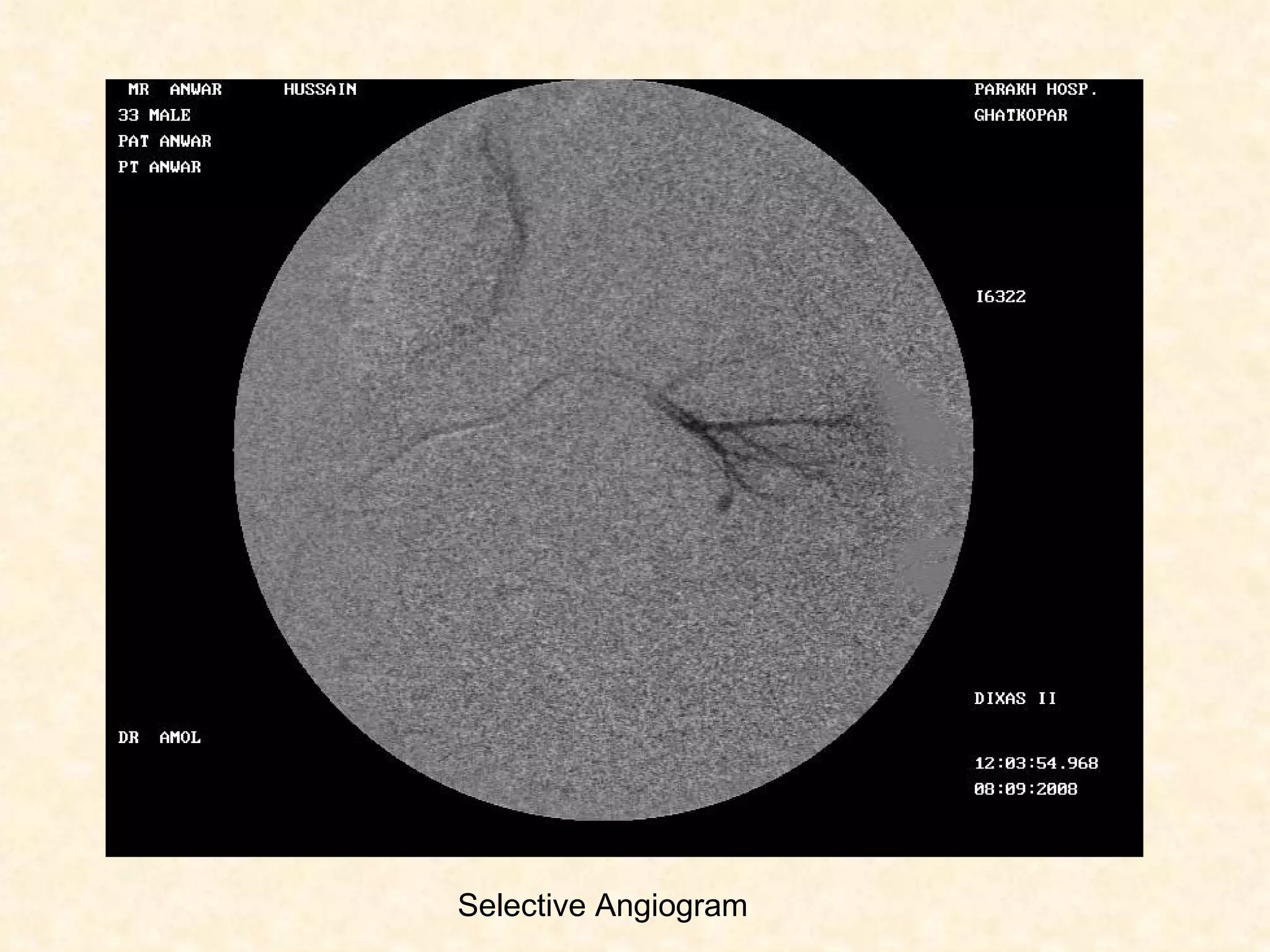 Embolisation for a post PCNL renal pseudoaneurysm. | PPT