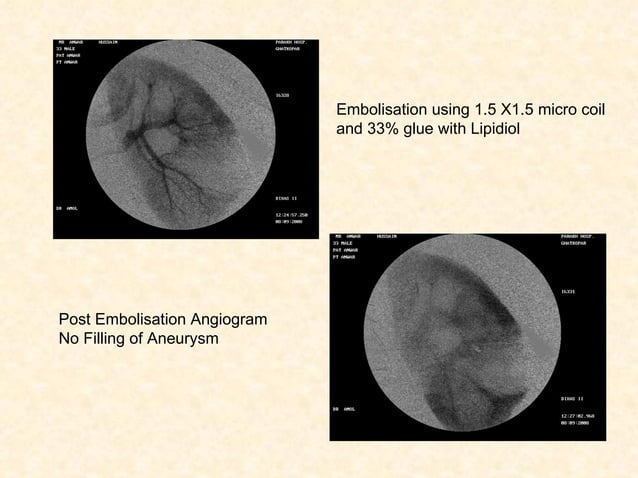 Embolisation for a post PCNL renal pseudoaneurysm. | PPT