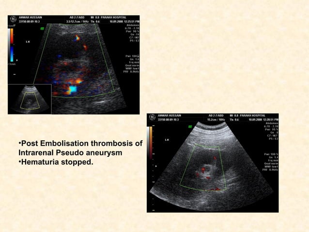 Embolisation for a post PCNL renal pseudoaneurysm. | PPT