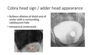 Ureterocele Adder Head
