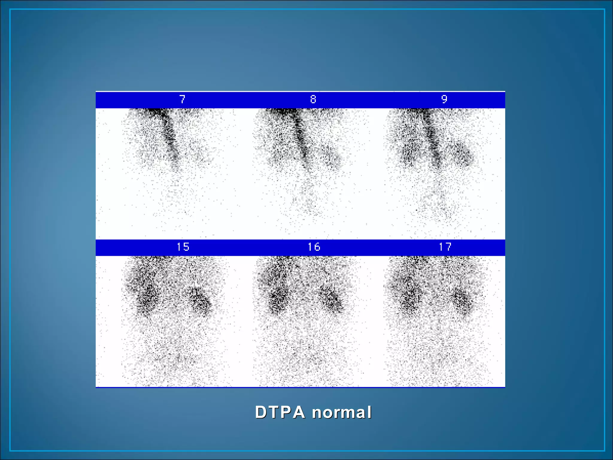 Renal scintigraphy | PPT
