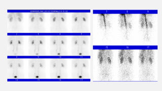 RENAL SCINTIGRAPHY, ADRENAL SCINTIGRAPHY AND ADRENAL VENOUS.pptx